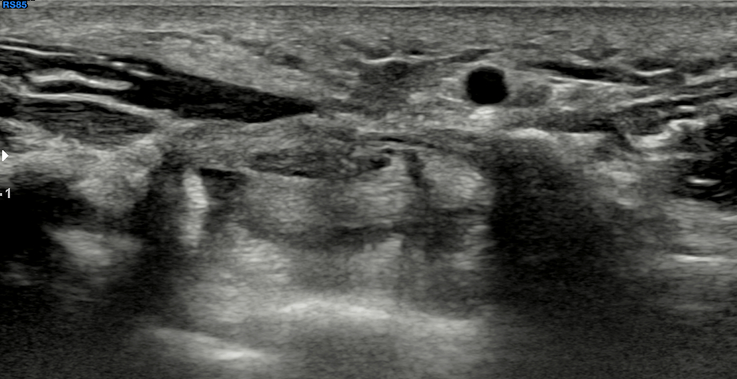 Trigger Finger Release with Ultrasound Guidance - Sonex Health